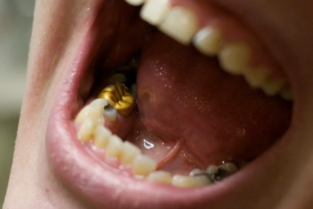 What Is Dental Gold? (Ultimate Guide)