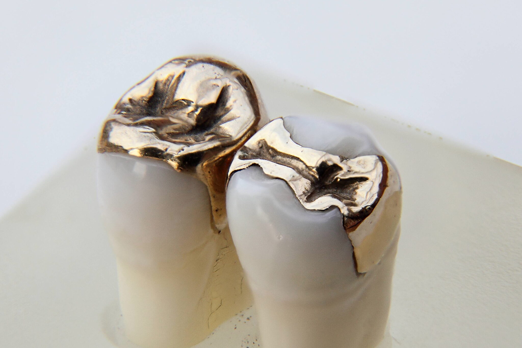 What Is Dental Gold? (Ultimate Guide)