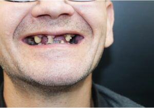 What To Eat With No Teeth? (Easy And Healthy Recipes)