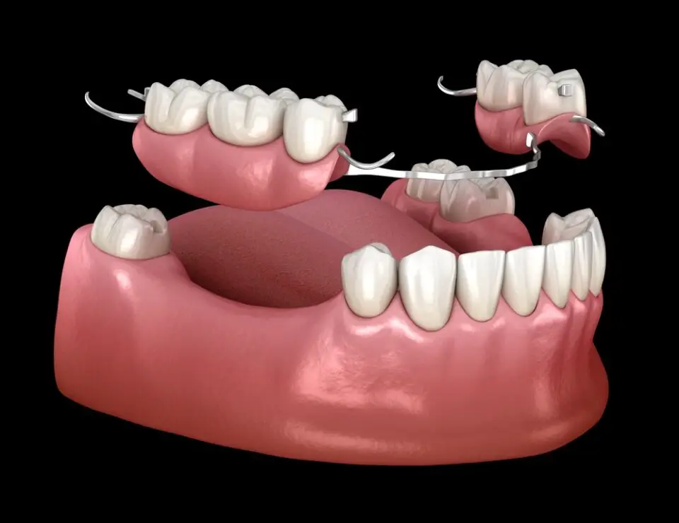 Can You Get Dentures If You Have No Teeth? (Pros & Cons Of Complete ...