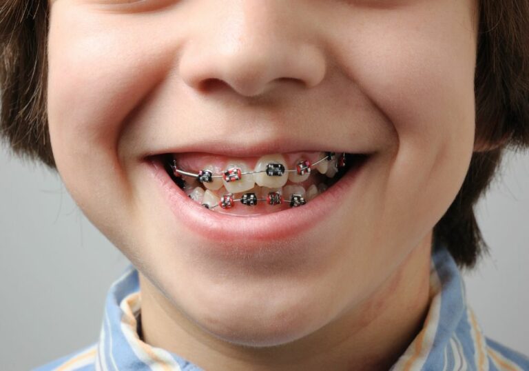 What Color Braces Make Your Teeth Look Whiter? (7 Tips For Choosing)