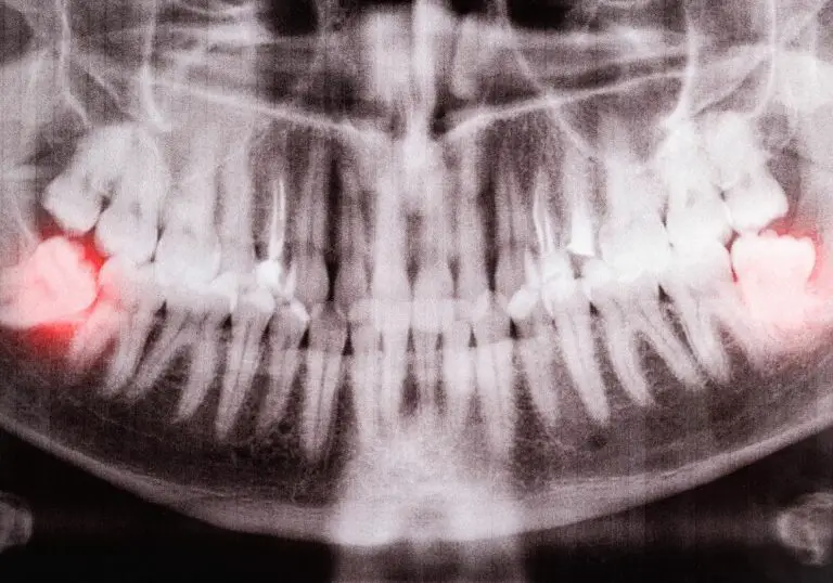 How To Treat A Dental Cyst At Home? (Easy To Follow)