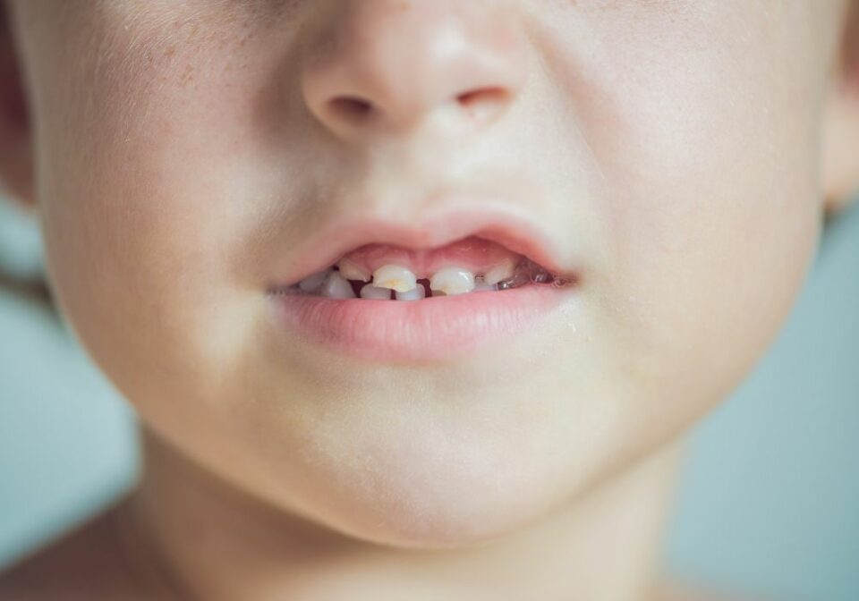 When Do Baby Teeth Fall Out? (With Caring Tips)