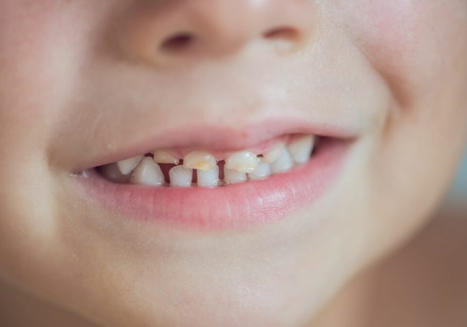 When Do Baby Teeth Fall Out? (With Caring Tips)