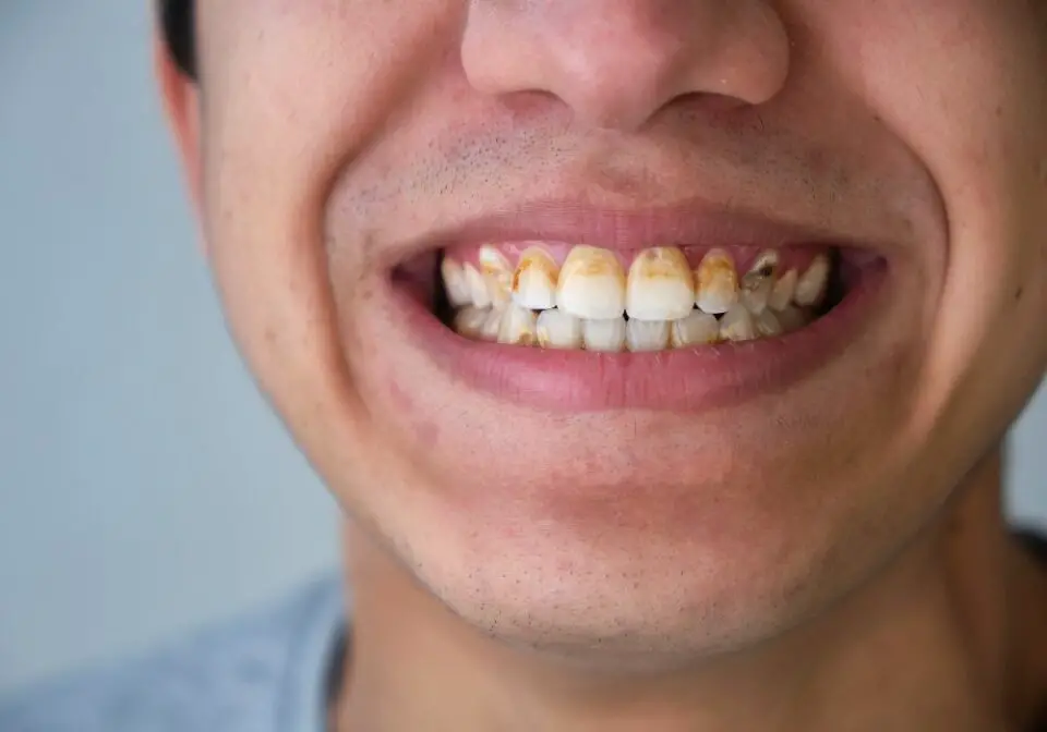 Can A Slightly Chipped Tooth Heal? (Causes & Treatments)