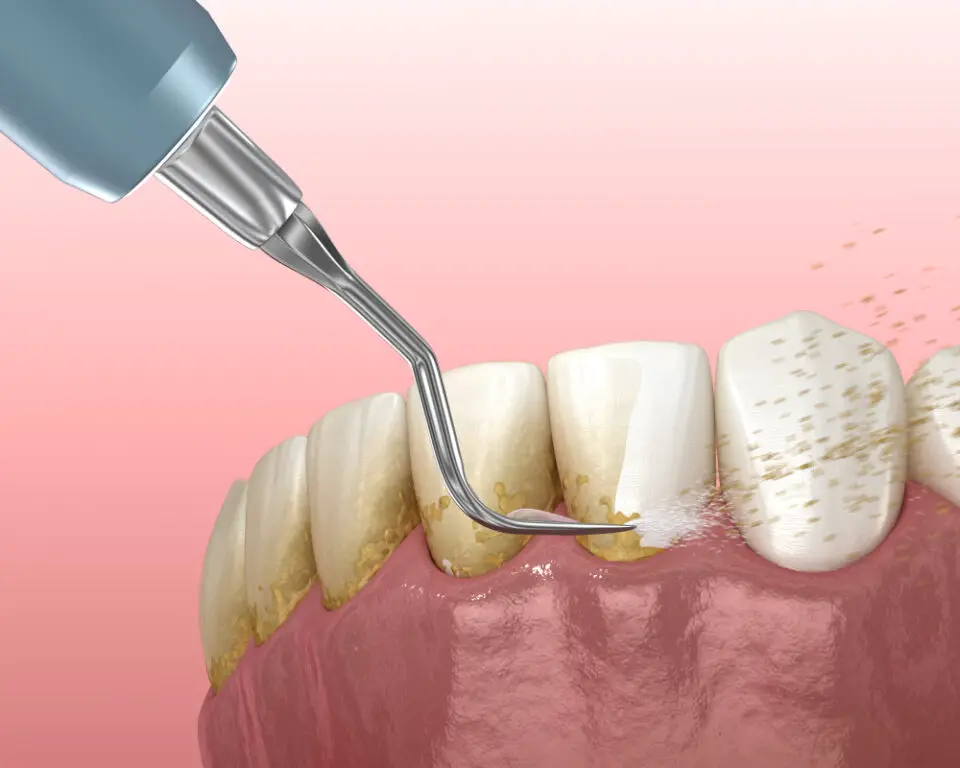 Why Do My Teeth Keep Breaking? (Common Causes & Preventions)