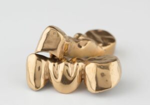Gold Tooth Replacement: Can You Replace a Missing Tooth with a Gold Tooth?