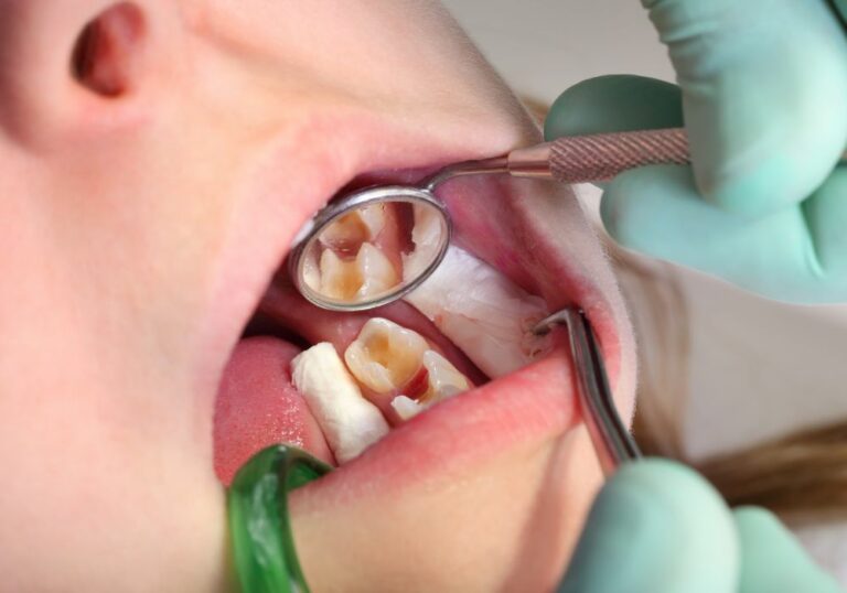 Can A Big Hole In Tooth Be Filled? (Causes & Filling Options)