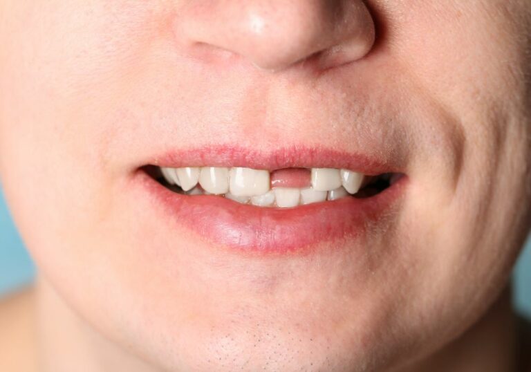 Can You Bond A Broken Front Tooth? (Ultimate Guide)