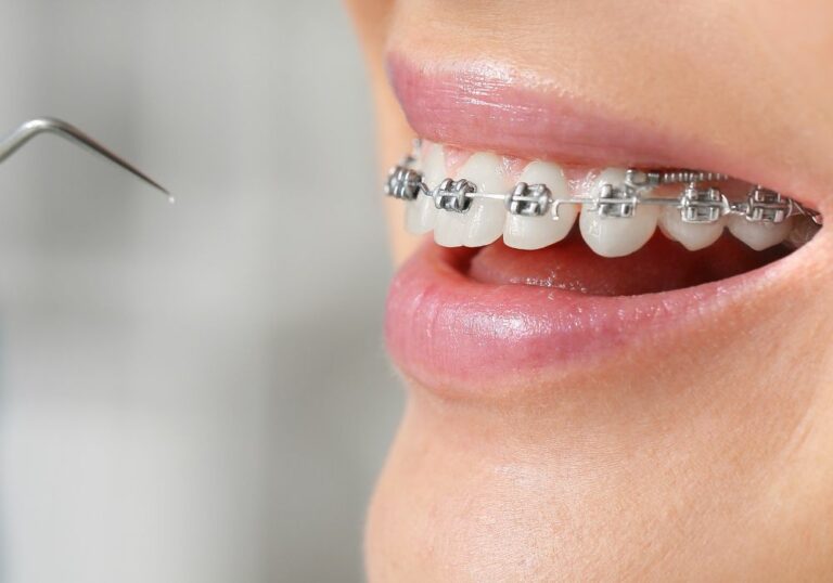 Can Braces Push a Long Tooth Further into the Gums? Exploring the ...