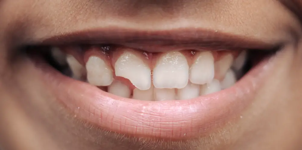 Can A Really Broken Tooth Be Fixed? (Everything You Need To Know)