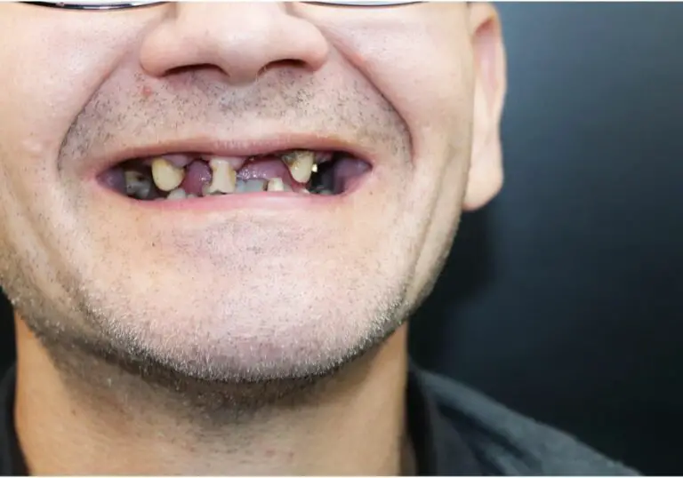 Can Rotten Front Teeth Be Fixed? (Everything You Need To Know)