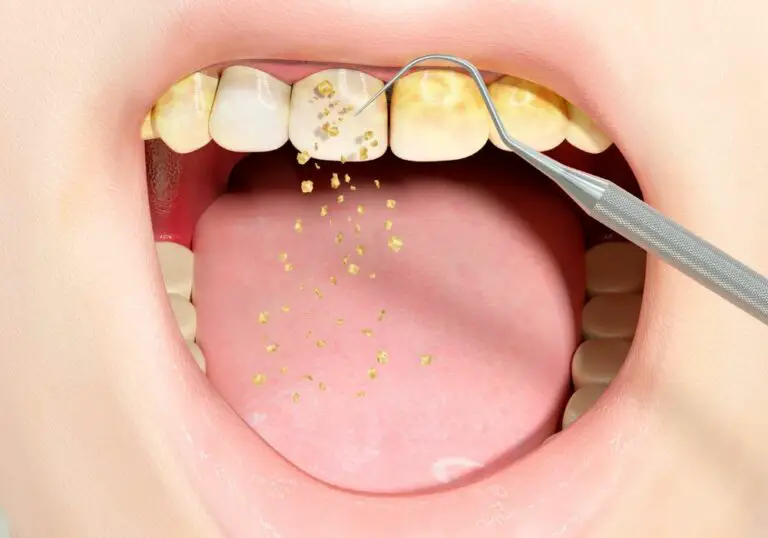 Can I Remove Calculus From My Teeth? (Calculus Removal Techniques)