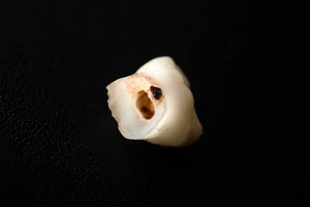 Can Teeth Holes Heal Themselves? Exploring the Possibility