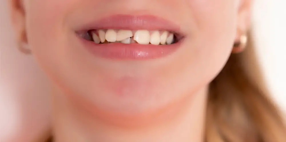 Why Are My Upper Front Teeth Bigger? (Causes & Treatment)