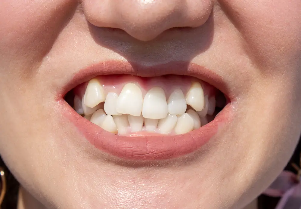 Can You Straighten A Crooked Tooth Tips And Options