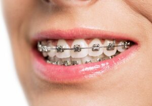 Can teeth shift back to normal? (5 Treatment options)