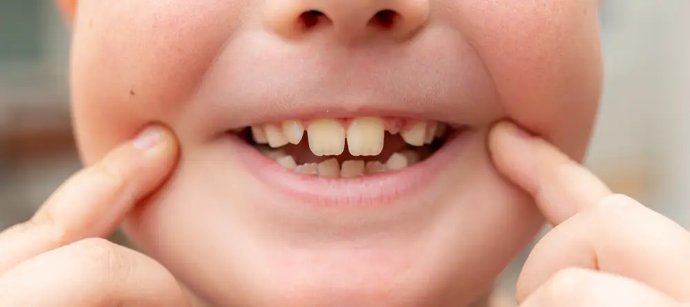 Do You Have 28 Teeth? Here's What You Need to Know