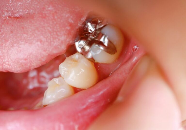 Why Silver Front Teeth? (History & Meaning)