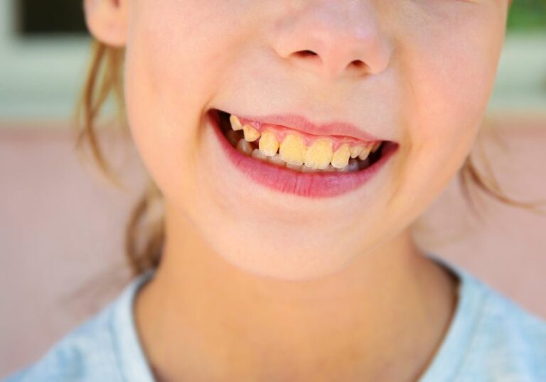 Why Is White Stuff Forming On My Teeth? (How To Remove Plaque)