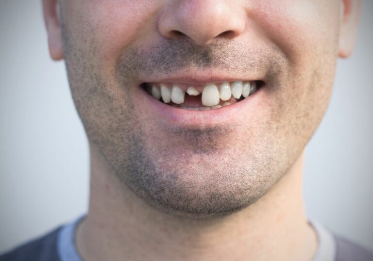 Can You Fix a Chipped Tooth Without a Veneer? Exploring Your Options