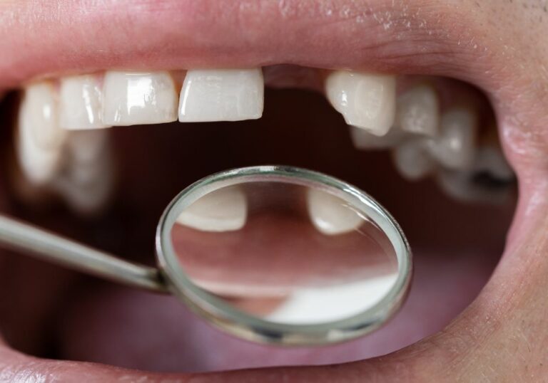 Why are my teeth breaking off all of a sudden? (Causes & Solutions)