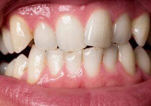 Why Have My Teeth Suddenly Shifted? (Causes & Prevention Tips)