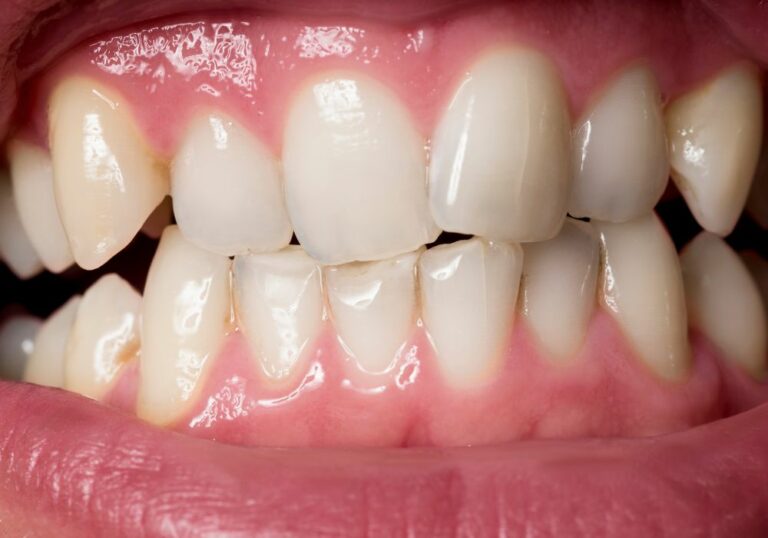 Why Have My Teeth Suddenly Shifted? (Causes & Prevention Tips)