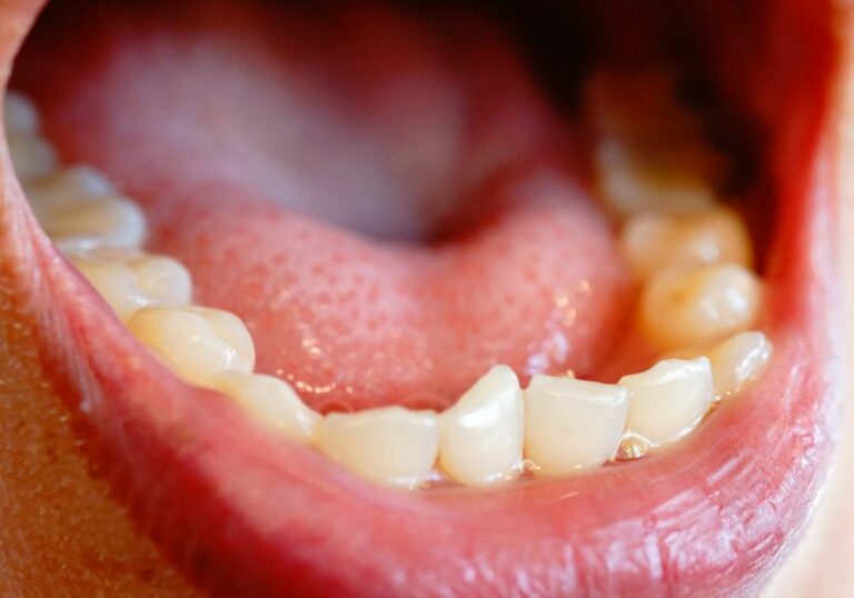 Why Are My Bottom Teeth Getting So Crooked? (Causes & Treatments)