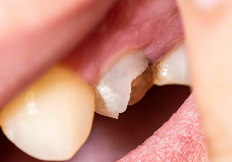 Why Are The Ends Of My Teeth Not Smooth? (Reasons & Treatments)