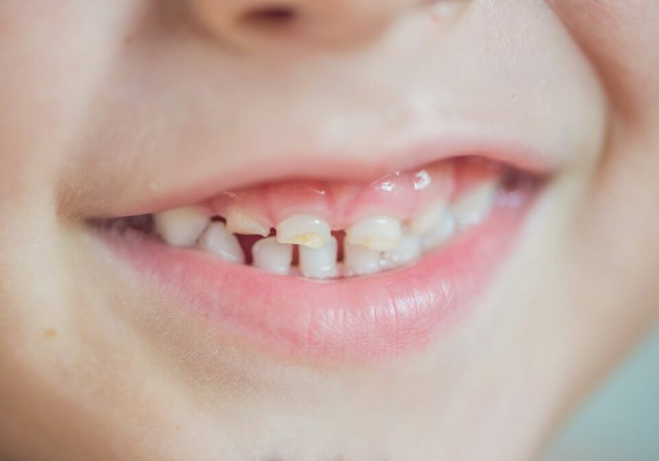How Long Do Teeth Last After Falling Out? (Everything You Need To Know)