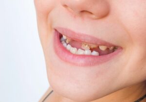 Why Are My Teeth Rotting And Breaking Off? (Causes & Treatments)