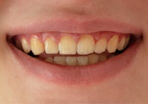 Why Is My Teeth Turning Grey? (Causes & Remedies)