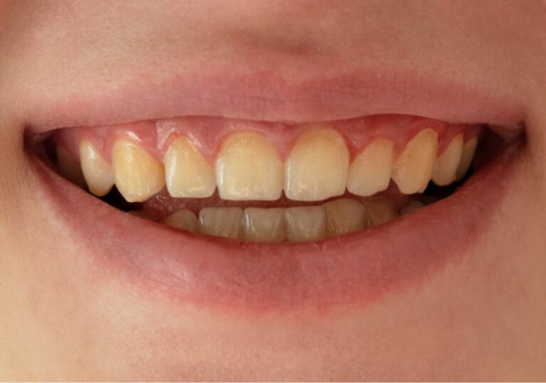 Why Is My Teeth Turning Grey? (Causes & Remedies)