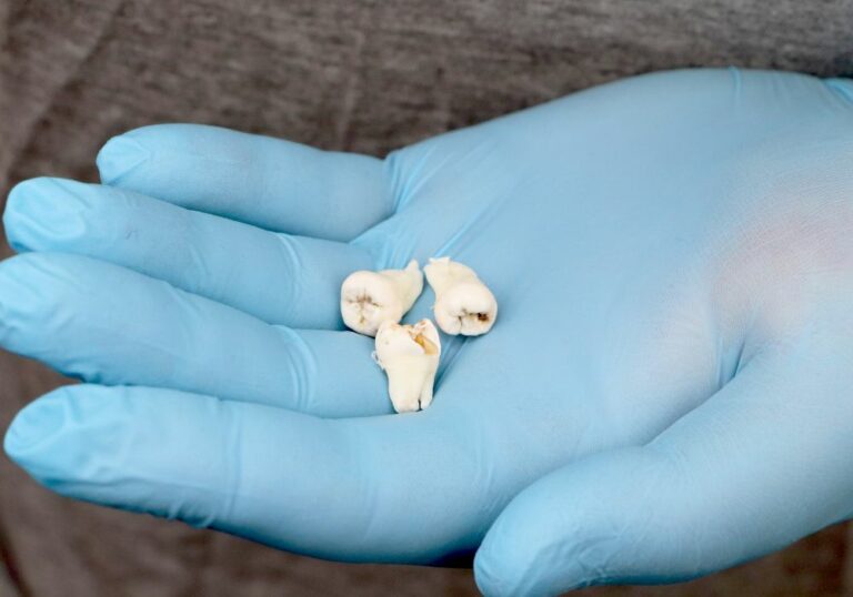 Why Can't I Keep My Extracted Wisdom Teeth? (Reasons & Other Options)