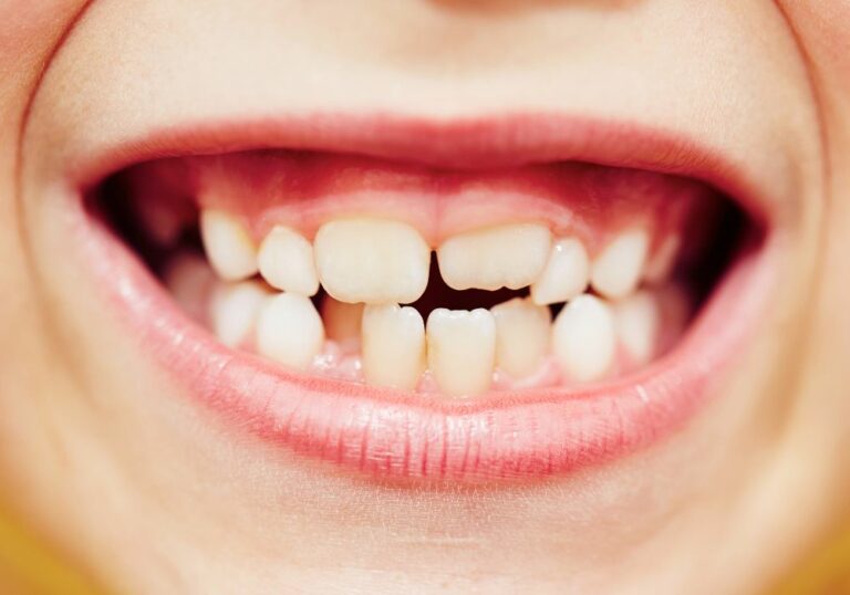 Why are my two front teeth becoming translucent? (Explained)