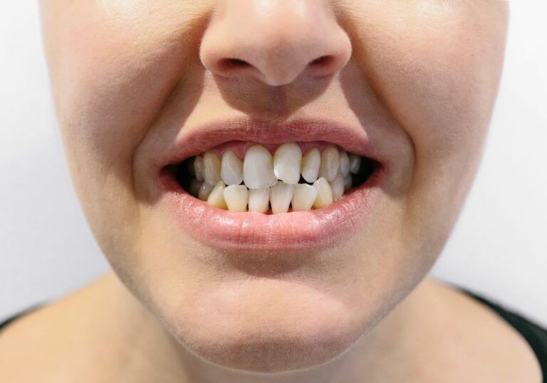 Can Overcrowding Teeth Be Fixed? Tips and Advice