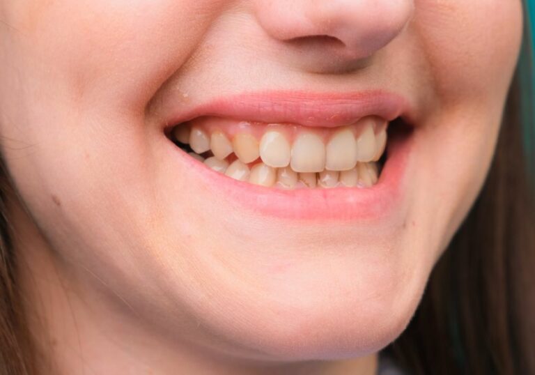 Why Are Teeth Not Naturally White? (Internal Discoloration & Extrinsic ...