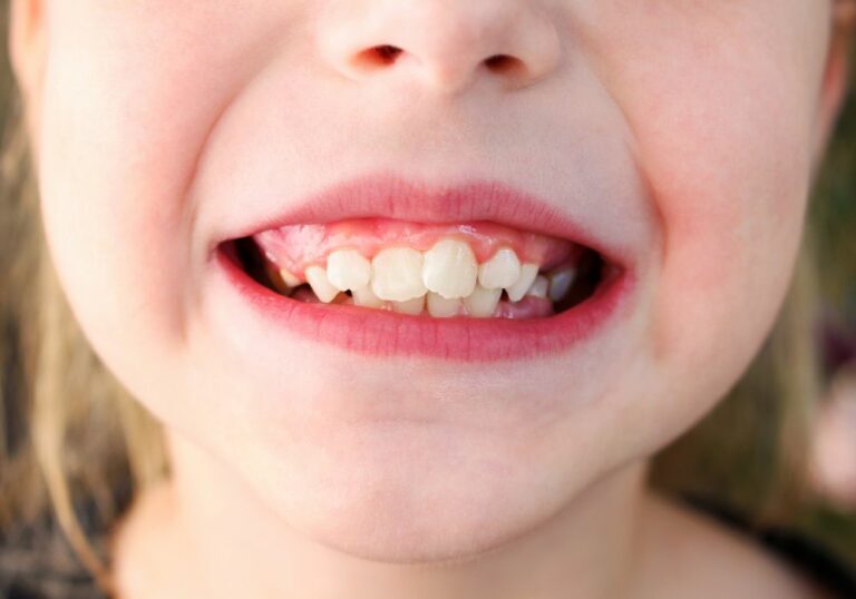 Why Are Crooked Teeth Attractive In Japan? (Origins, Culture & Worldview)