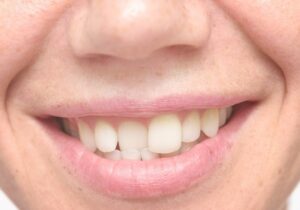 Why Is My Teeth Turning Grey? (Causes & Remedies)