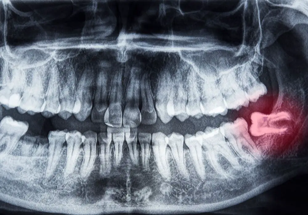 How long can you leave wisdom tooth pain? (Explained)