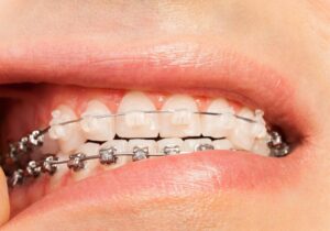 Can You Push a Tooth Forward? An In-Depth Look at Orthodontic Tooth ...
