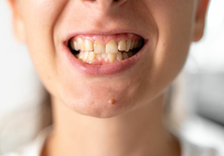 What Is The Best Treatment for Crowded Teeth? (5 Common Orthodontic ...