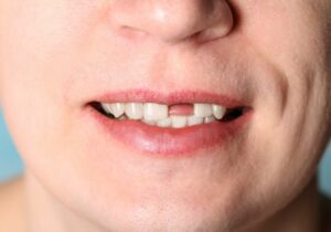 How Quickly Can A Front Tooth Be Replaced? (Replacement Options)