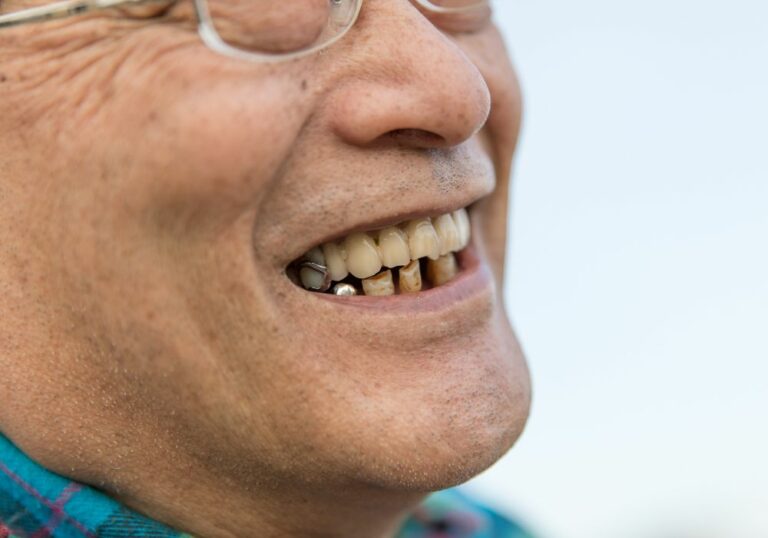 Why Are My Teeth Turning Black In Between? (Causes & Treatments)