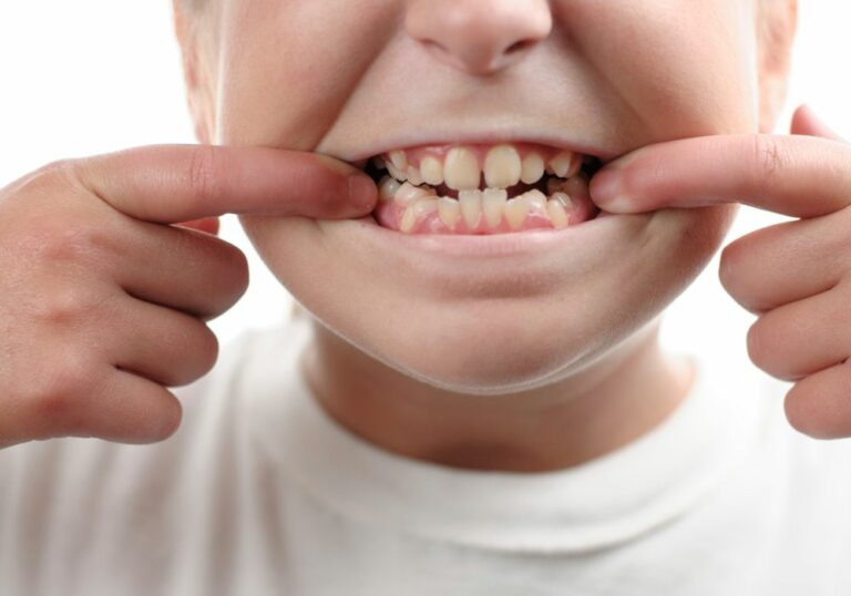 Why Are My Bottom Teeth Getting So Crooked? (Causes & Treatments)