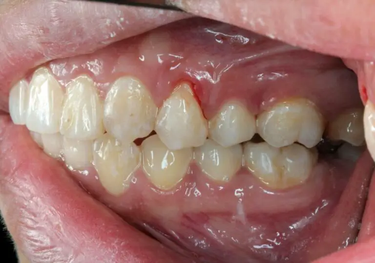 Why Won't My Gums Stop Bleeding? (Causes & Prevention Tips)