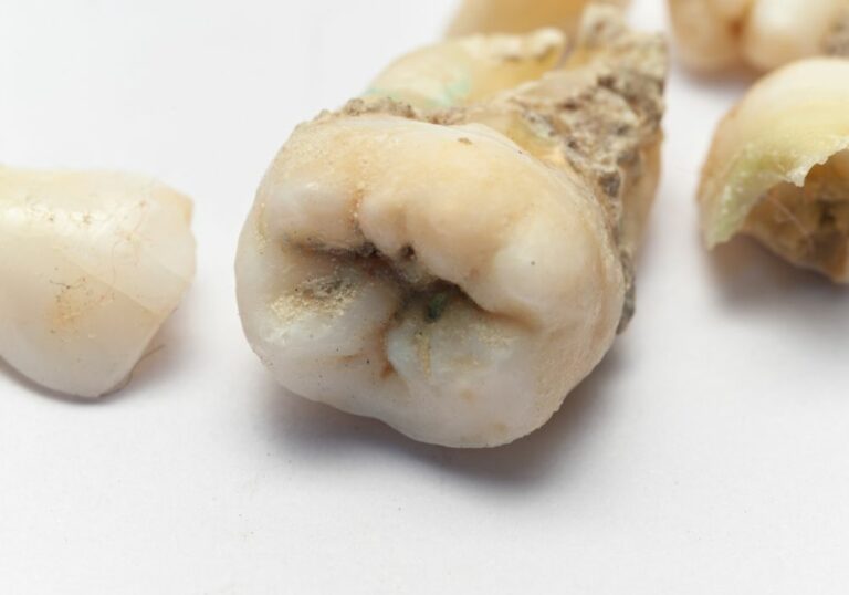 What Diseases Can Rotten Teeth Cause? (Symptoms & Treatments)