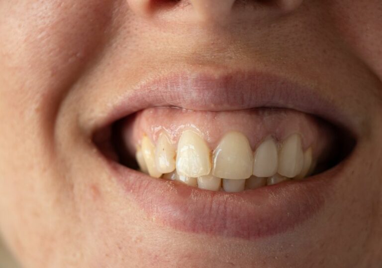Why Are My Teeth Shifting As I Get Older? (Factors & Prevention)