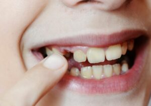 Why Are My Teeth Rotting And Breaking Off? (Causes & Treatments)